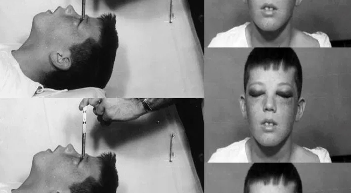 Lobotomía, el cruel y antiguo tratamiento psiquiátrico que horrorizó al ...