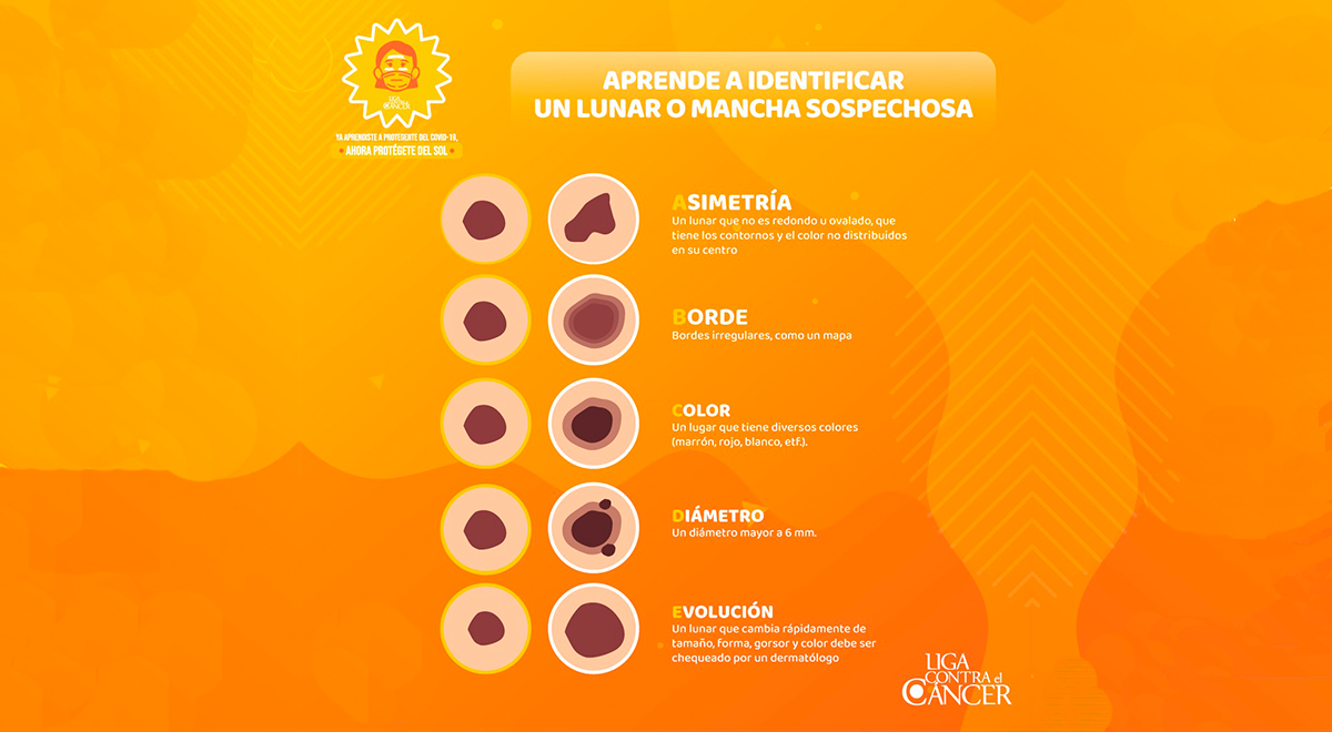 Cáncer: Lunares y manchas en la piel, ¿cúando son peligrosos? | El Popular