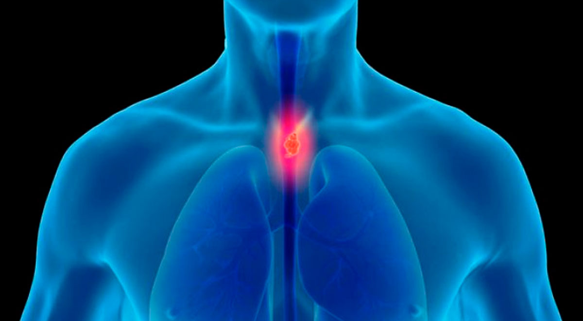 Cáncer de esófago: síntomas iniciales, tratamiento, ¿tiene cura ...