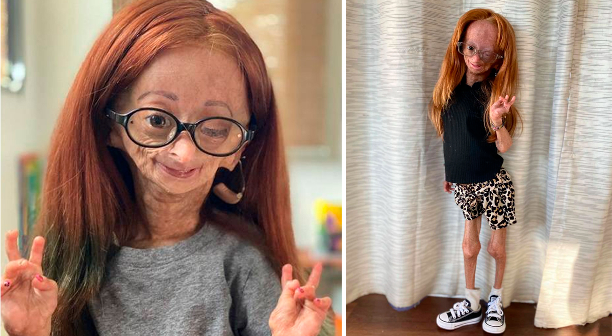 Adalia Rose Williams murió, youtuber de 15 años que padecía el síndrome ...