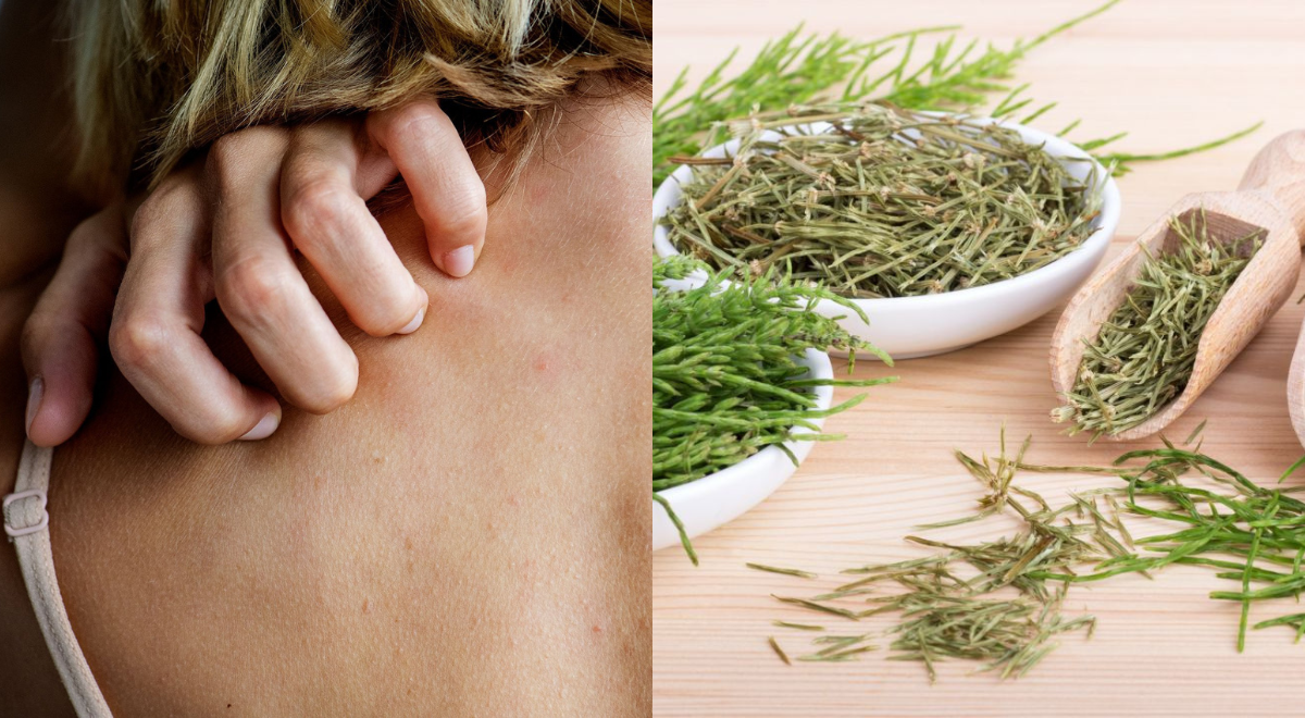 Remedios caseros: Así puedes aliviar la picazón en el cuerpo con estos ...