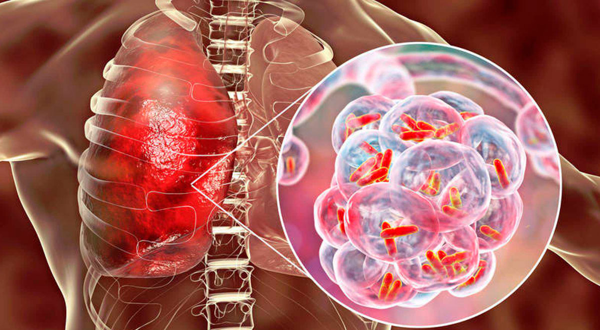 Tuberculosis pulmonar, síntomas, que es, tratamiento, ¿cómo se contagia ...