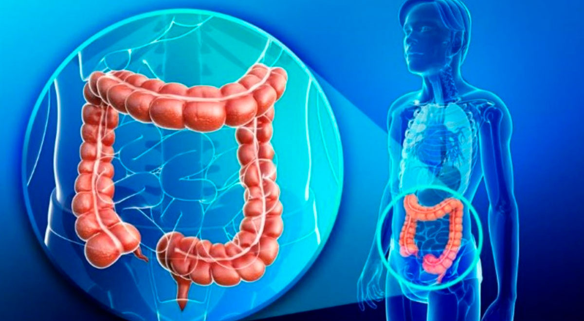 Cáncer de colon: Cómo reconocer cuando el colon está inflamado | El Popular
