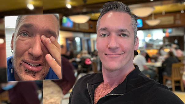 EE.UU. | Wesley Wallace: hombre contagiado de viruela del mono revela dolorosos síntomas tras ...