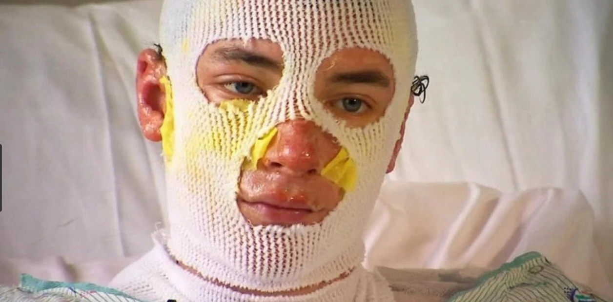 Estados Unidos | Derrick Byrd foto viral: Joven de 20 años se quemó ...