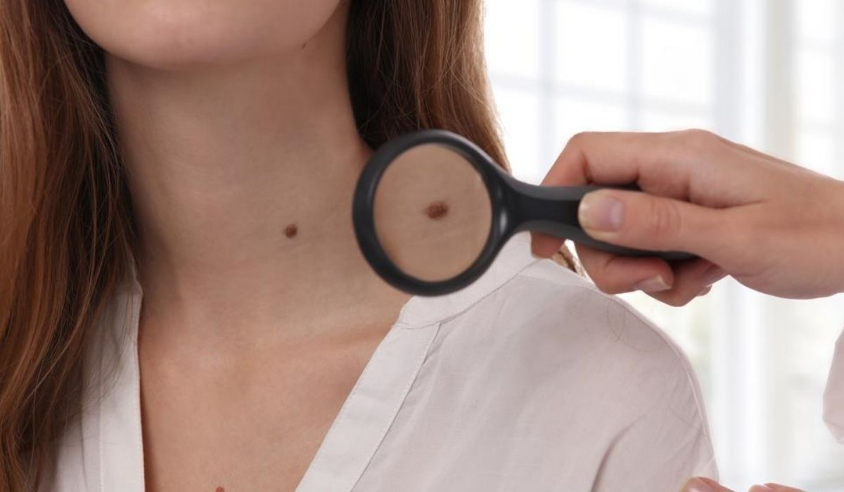 Día del Lunar: ¿Sabes cómo identificar un lunar peligroso?, cáncer ...
