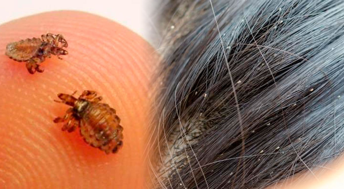 Soñar con piojos y liendres: qué significa, interpretación de sueños ...